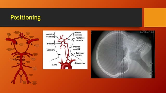 Ct Brain Perfusion - Toshiba Aquilion 64 | PPTX
