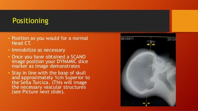 Ct Brain Perfusion - Toshiba Aquilion 64