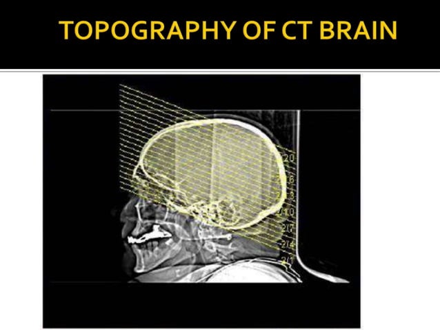 CT Brain | PPTX