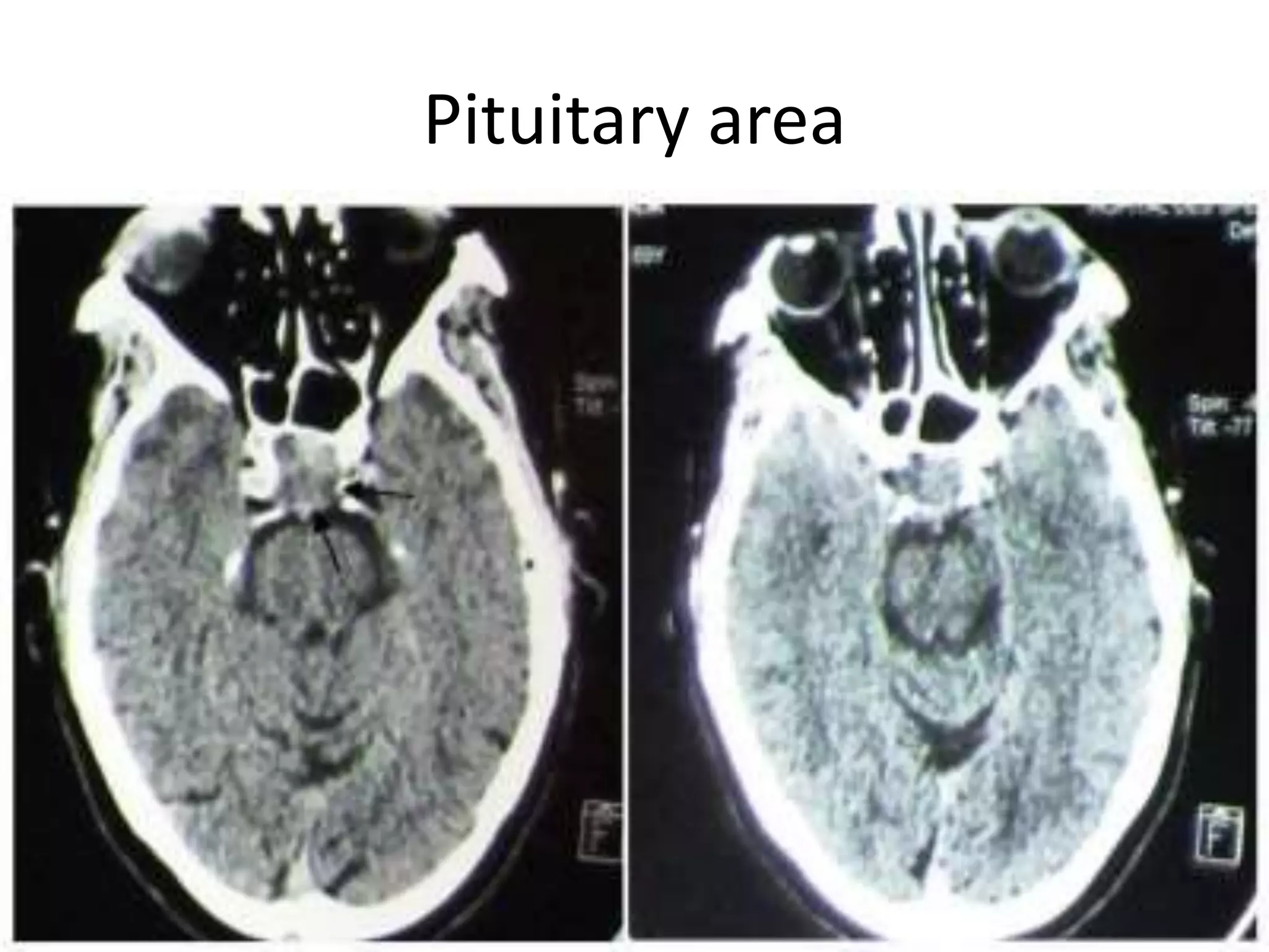 Ct brain presentation | PPTX