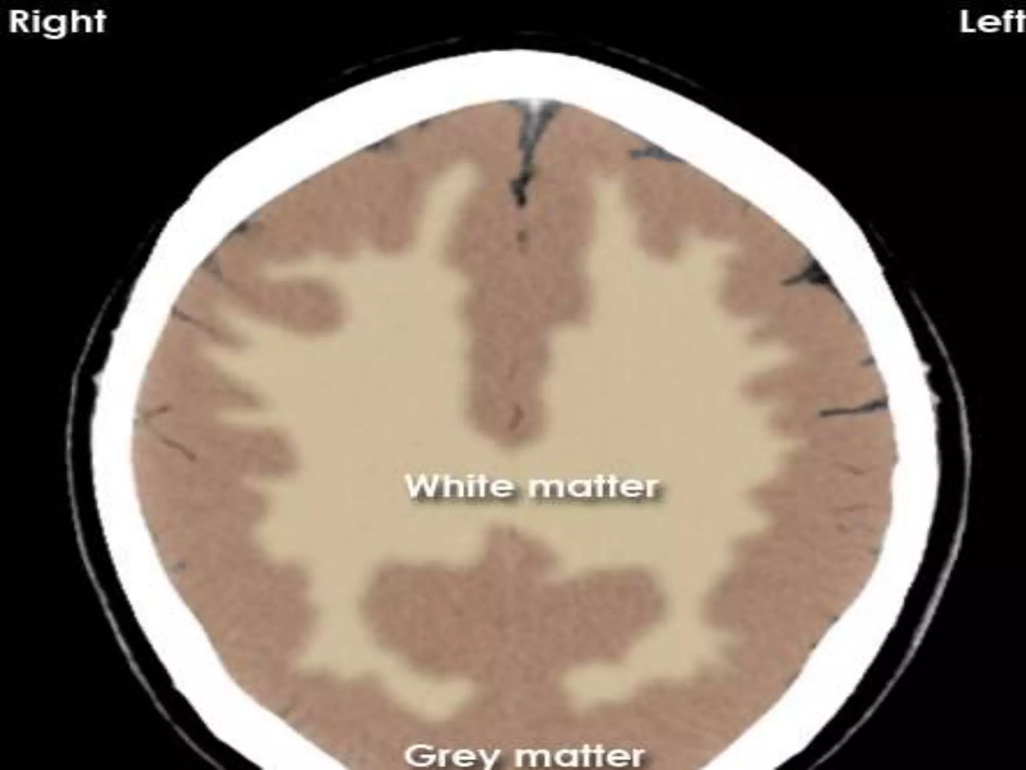 Ct brain presentation | PPTX