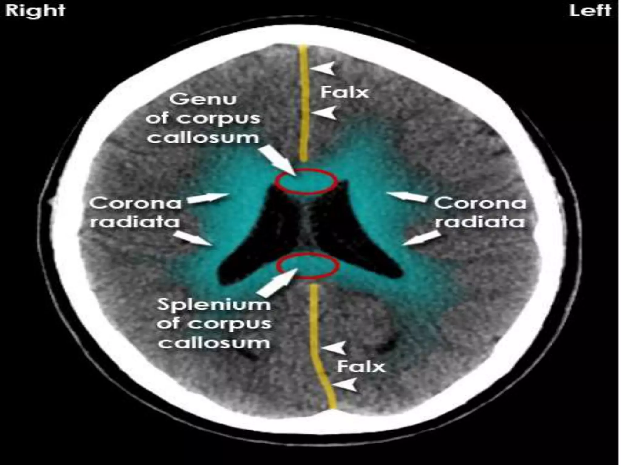 Ct brain presentation | PPTX