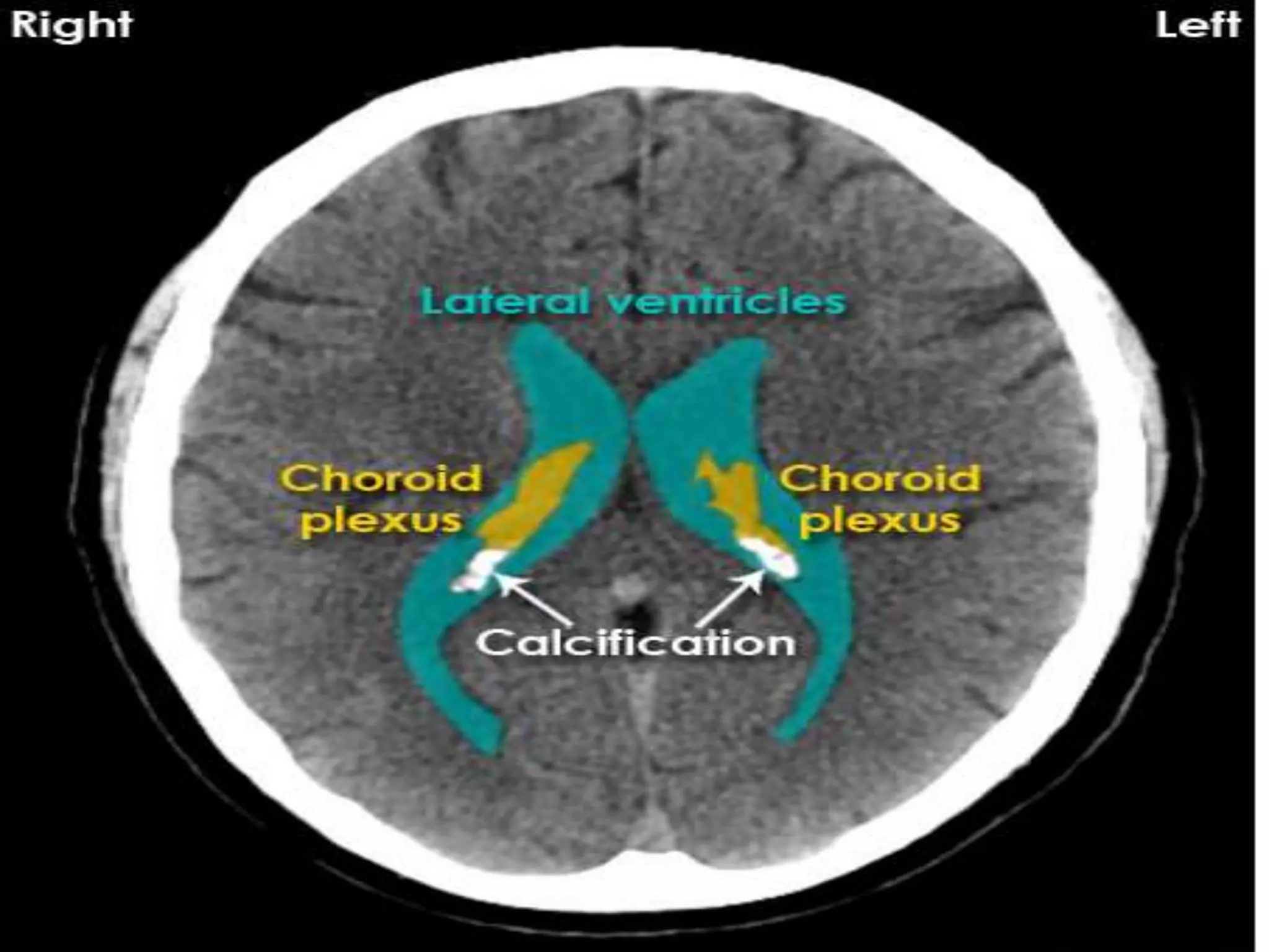 Ct brain presentation | PPTX