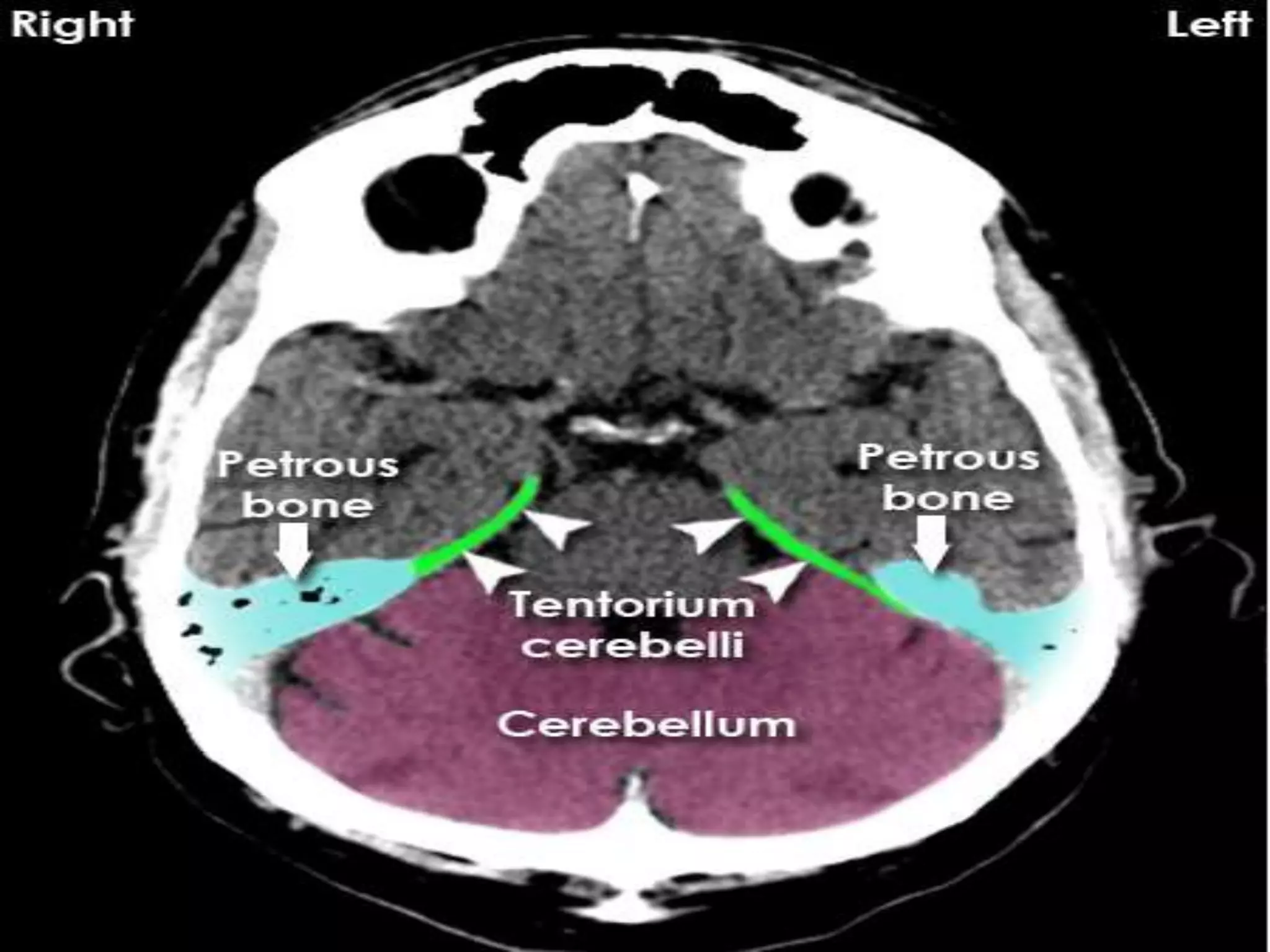 Ct brain presentation | PPTX