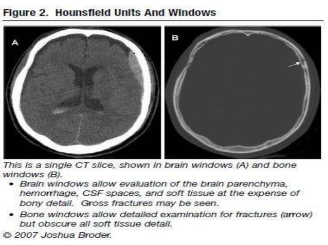 Ct brain presentation | PPTX