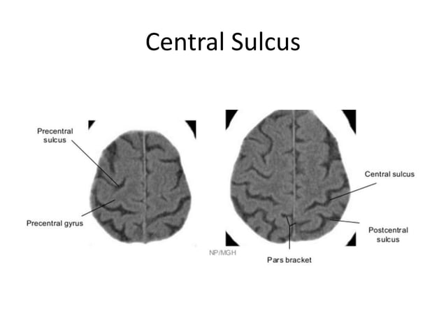 Ct brain presentation | PPTX
