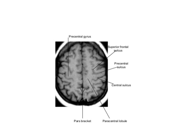 Ct brain presentation | PPTX