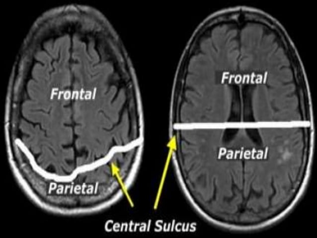 Ct brain presentation | PPTX