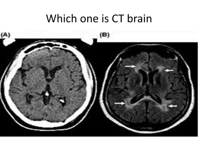 Ct brain presentation | PPTX