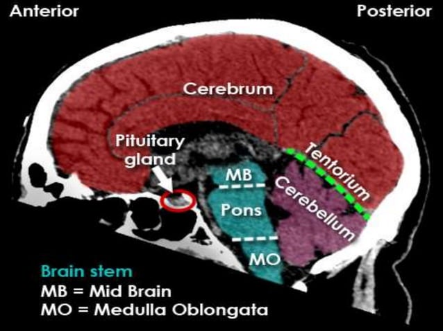 Ct brain presentation | PPTX