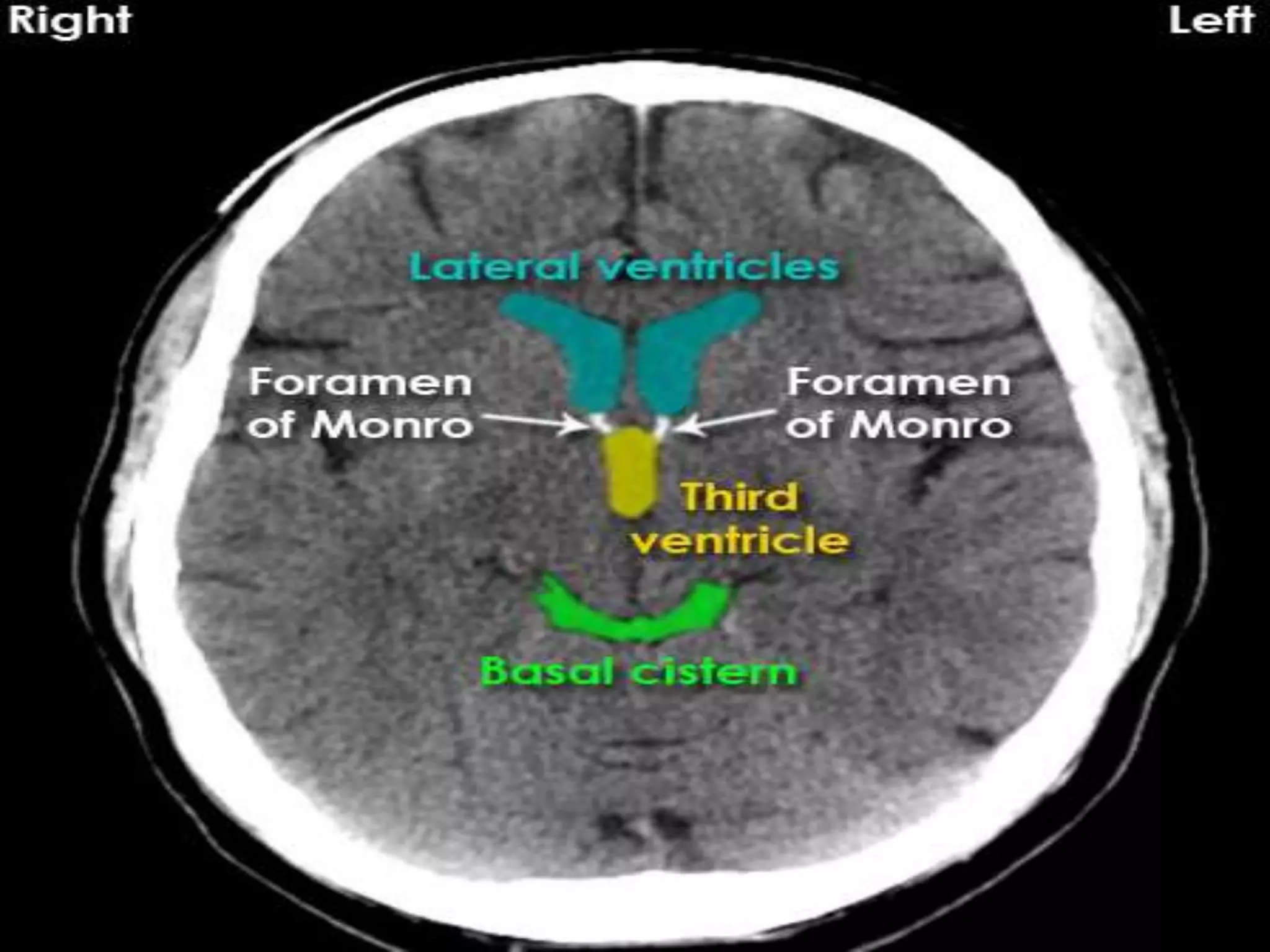 Ct brain presentation | PPTX