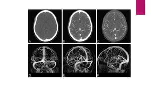 CT Brain Venogram in medical imaging.ppt