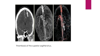 CT Brain Venogram in medical imaging.ppt