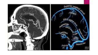 CT Brain Venogram in medical imaging.ppt