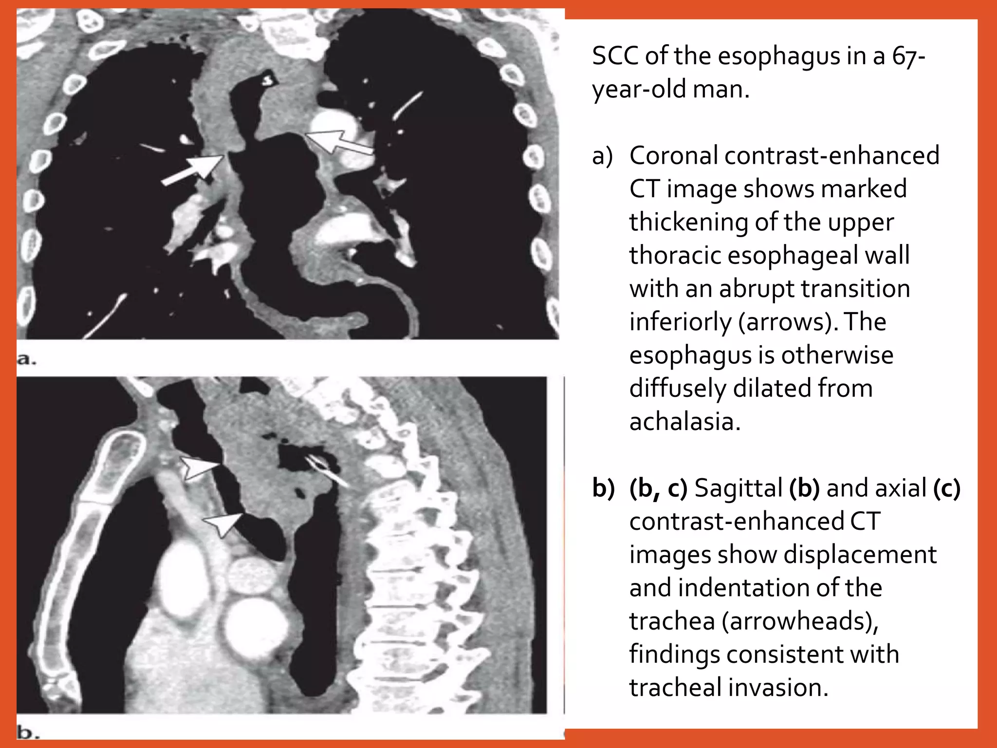 CT Imaging of CA Esophagus | PPTX