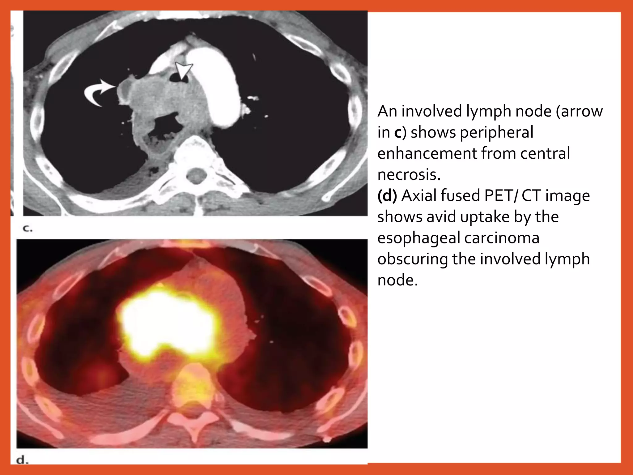 CT Imaging of CA Esophagus | PPTX