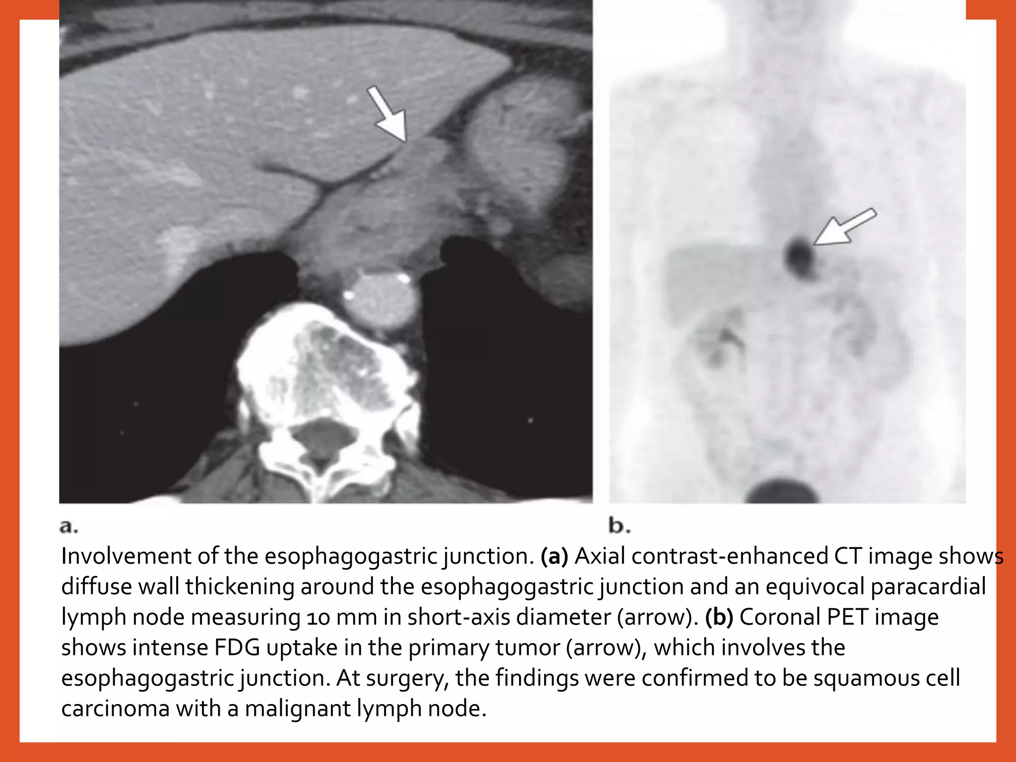 CT Imaging of CA Esophagus | PPTX