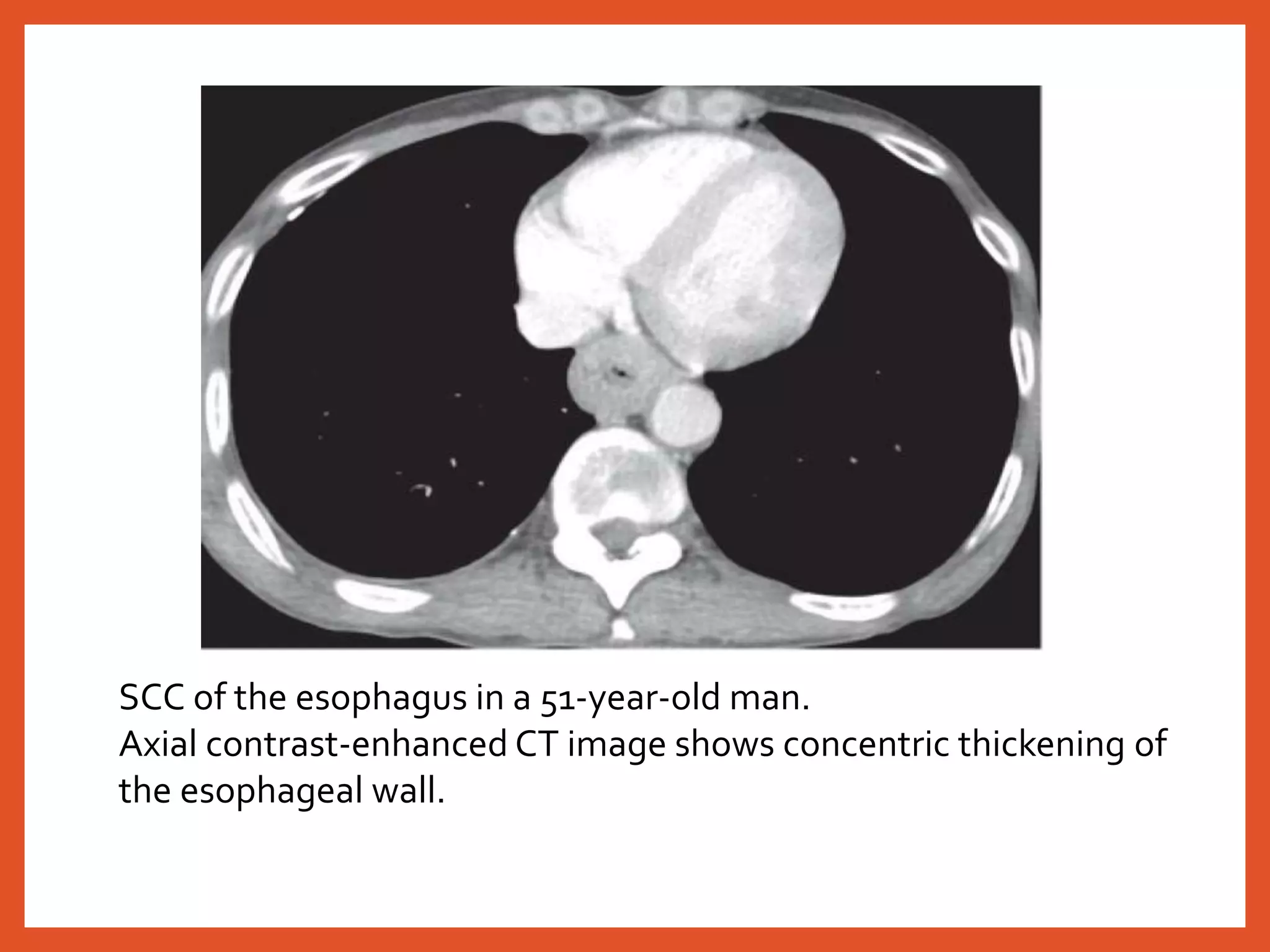 CT Imaging of CA Esophagus | PPTX