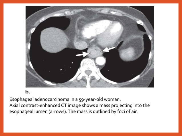 CT Imaging of CA Esophagus | PPTX | Cancer | Diseases and Conditions