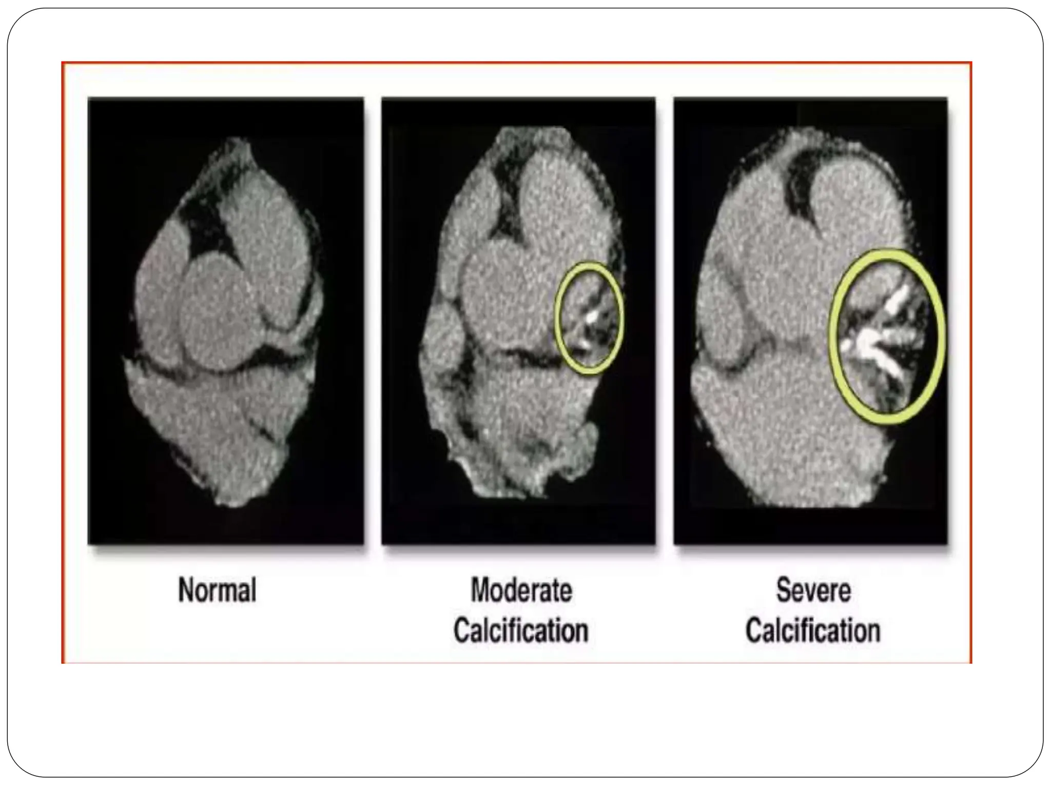 CT calcium score.pptx