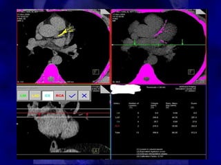 Ct calcium scoring 1 | PPT