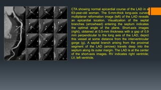 Cardiac CT Angiography to detect Myocardial Bridging | PDF