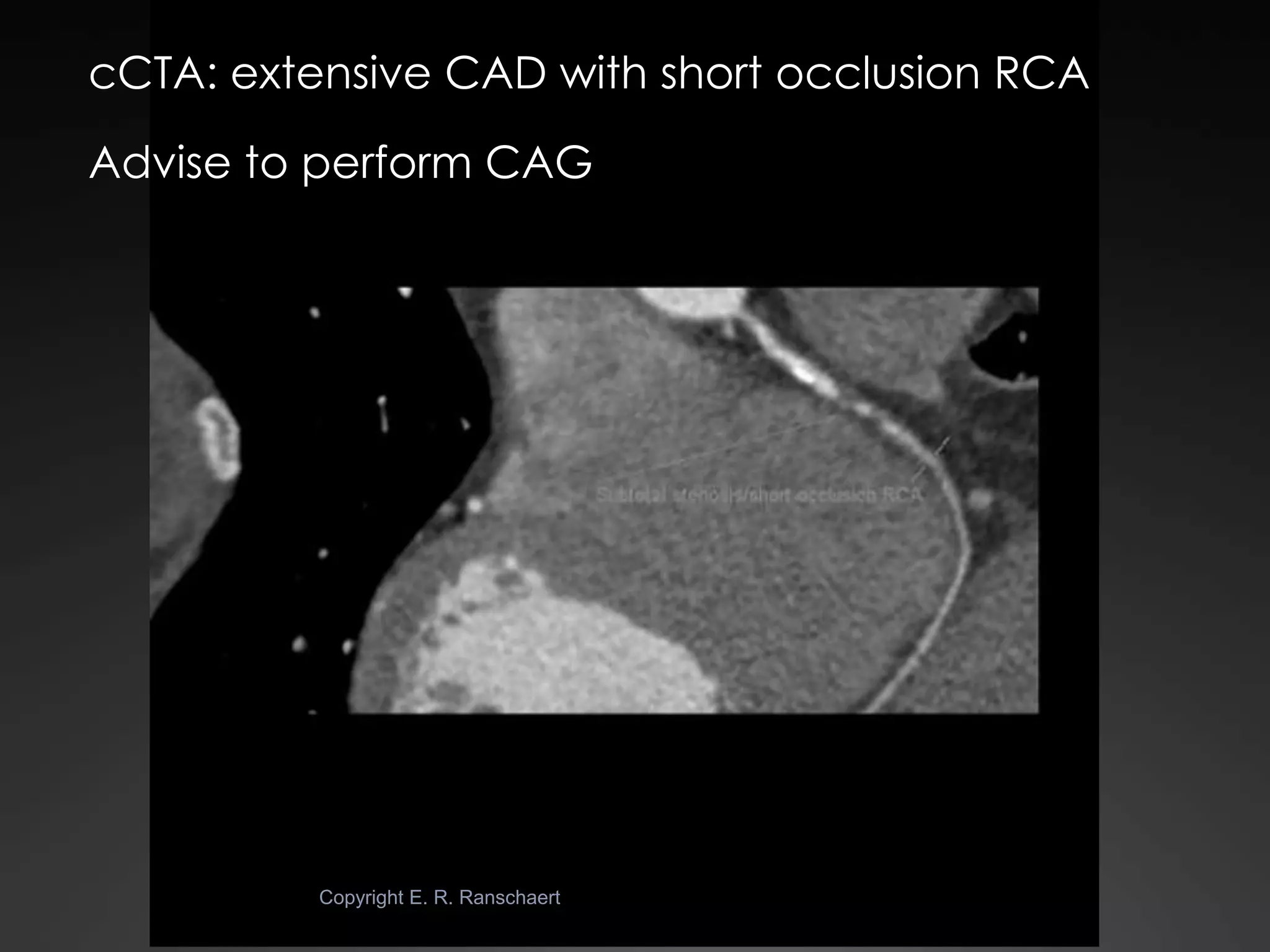 State-of-the-art Cardiac CT of the coronary arteries | PPTX