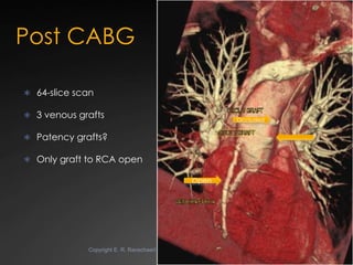 State-of-the-art Cardiac CT of the coronary arteries | PPTX