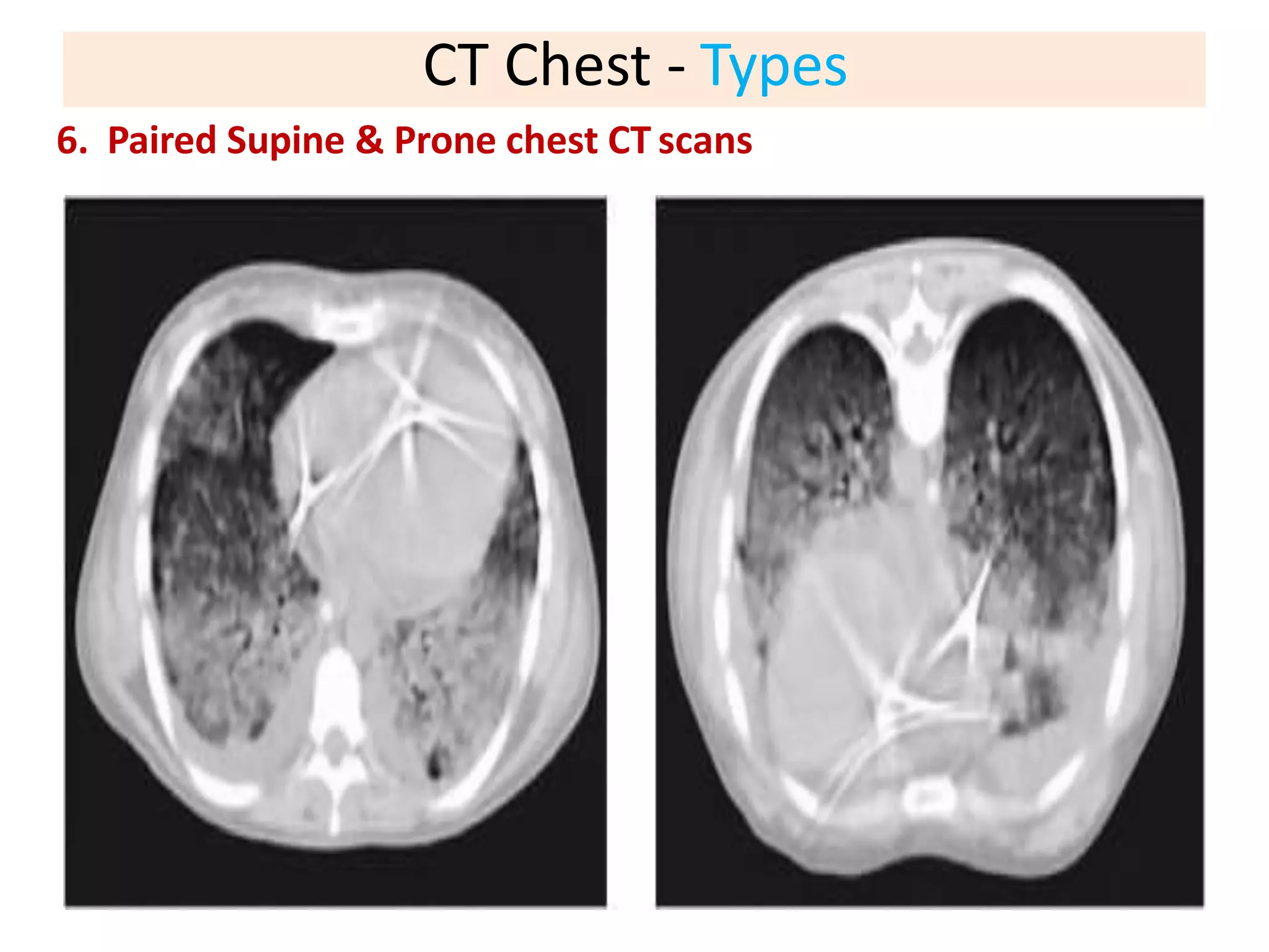 Basics of CT chest | PPTX | Lung and Respiratory Health | Diseases and ...