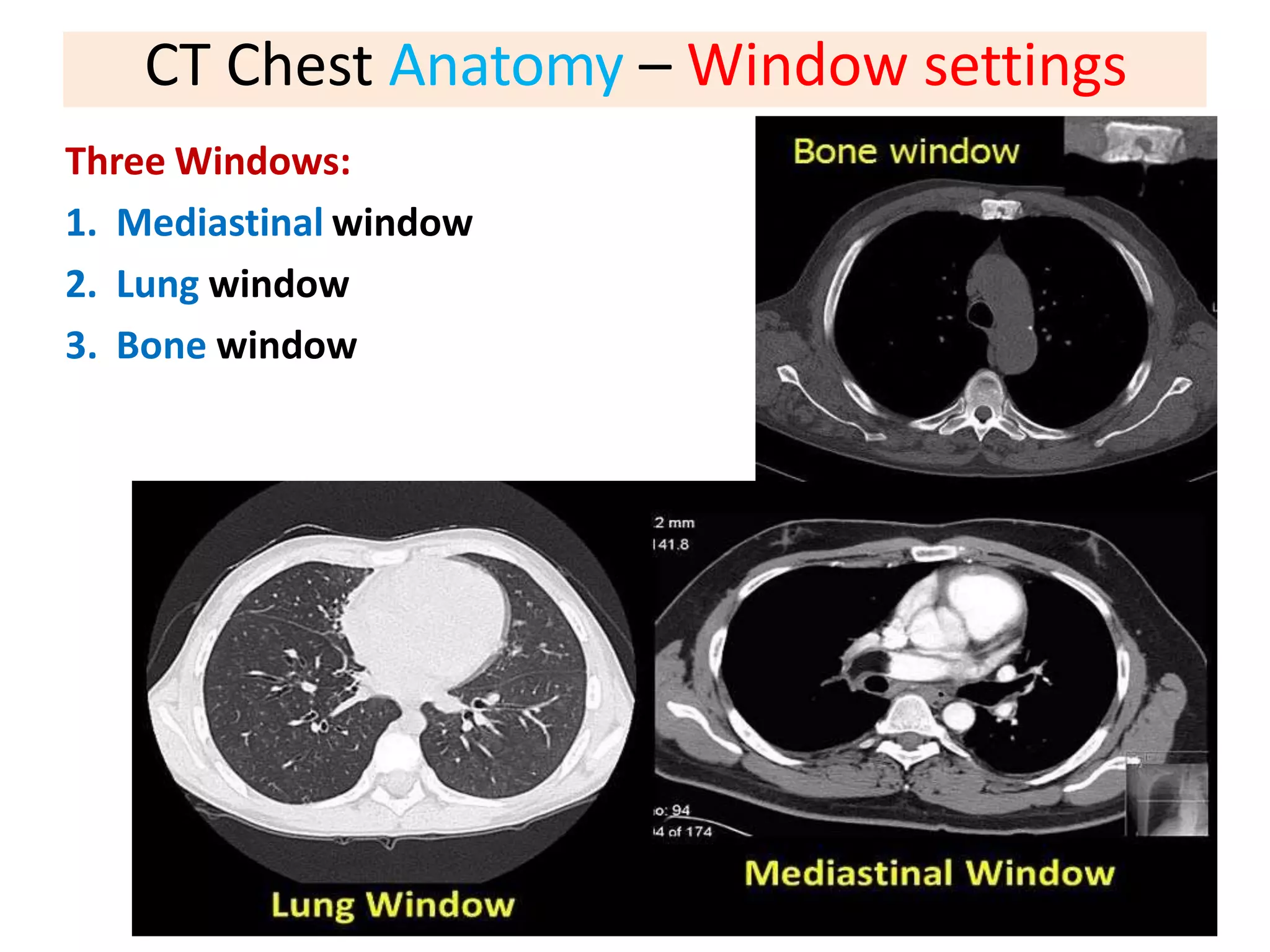Basics of CT chest | PPTX