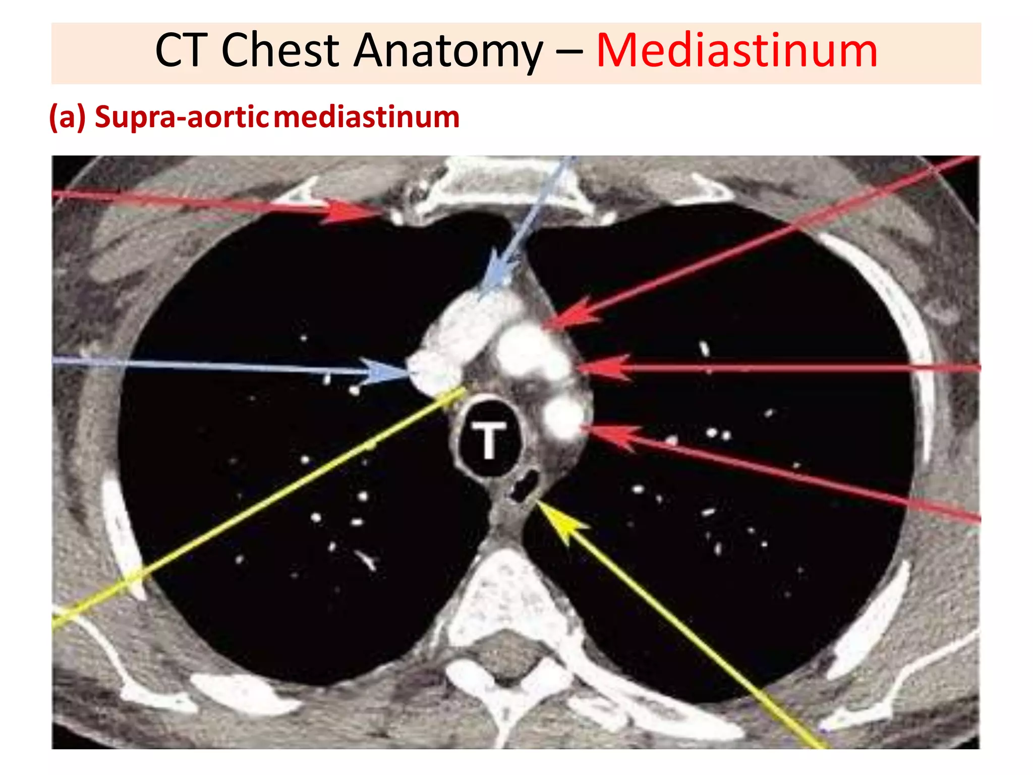 Basics of CT chest | PPTX | Lung and Respiratory Health | Diseases and ...