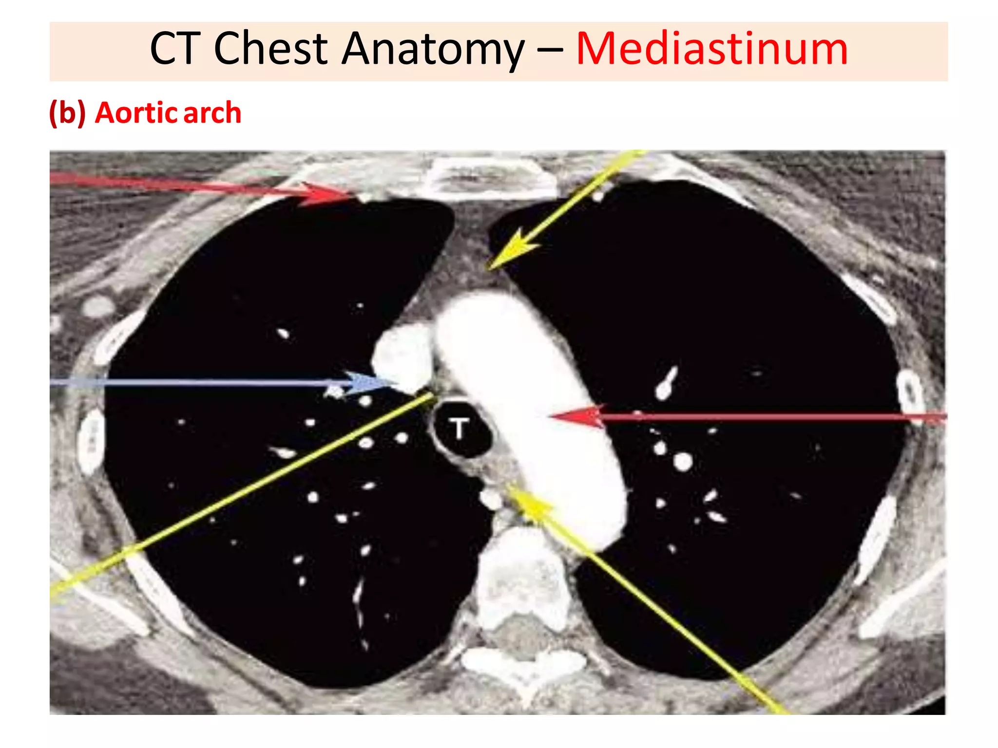 Basics of CT chest | PPTX