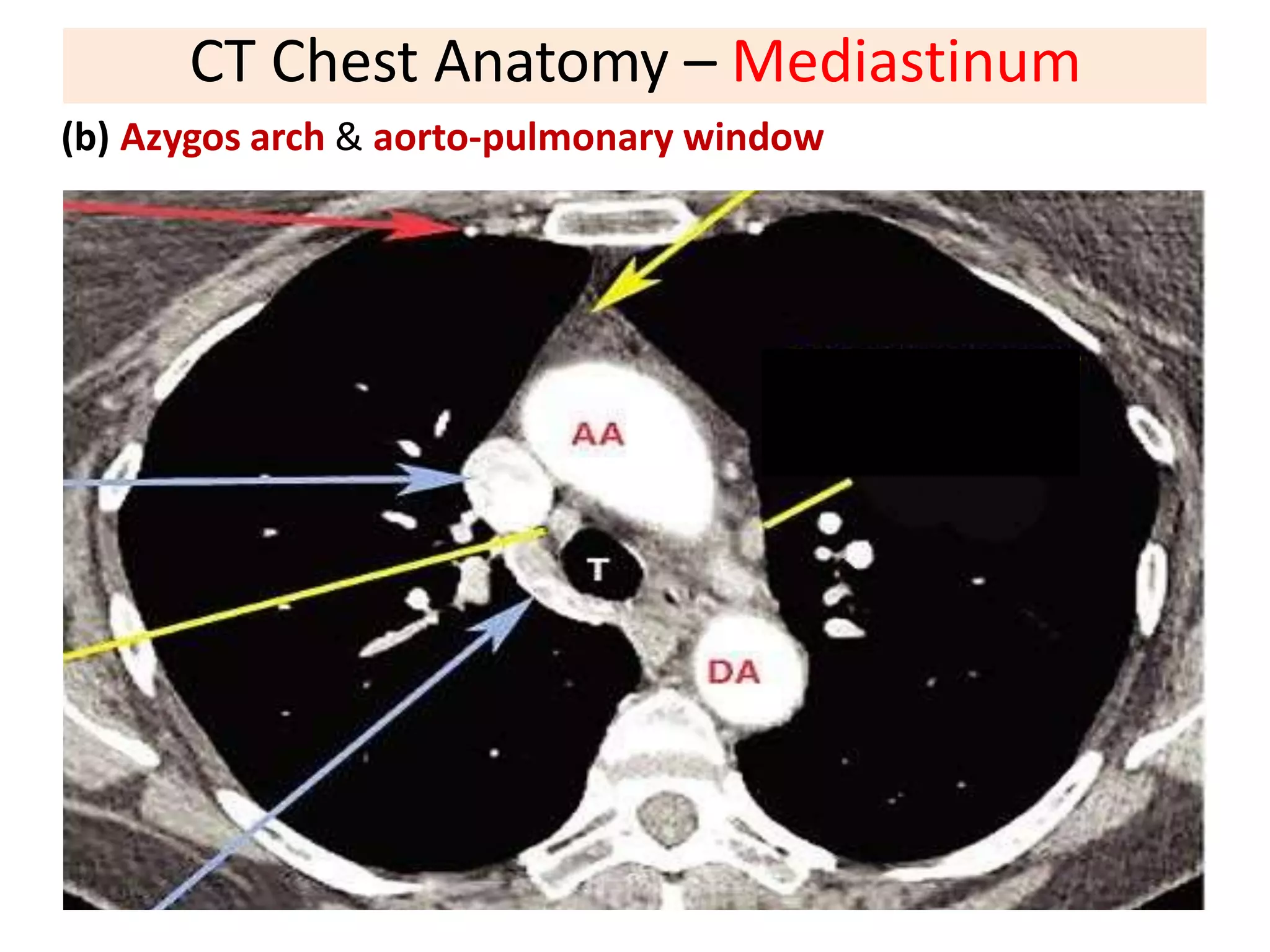 Basics of CT chest | PPTX