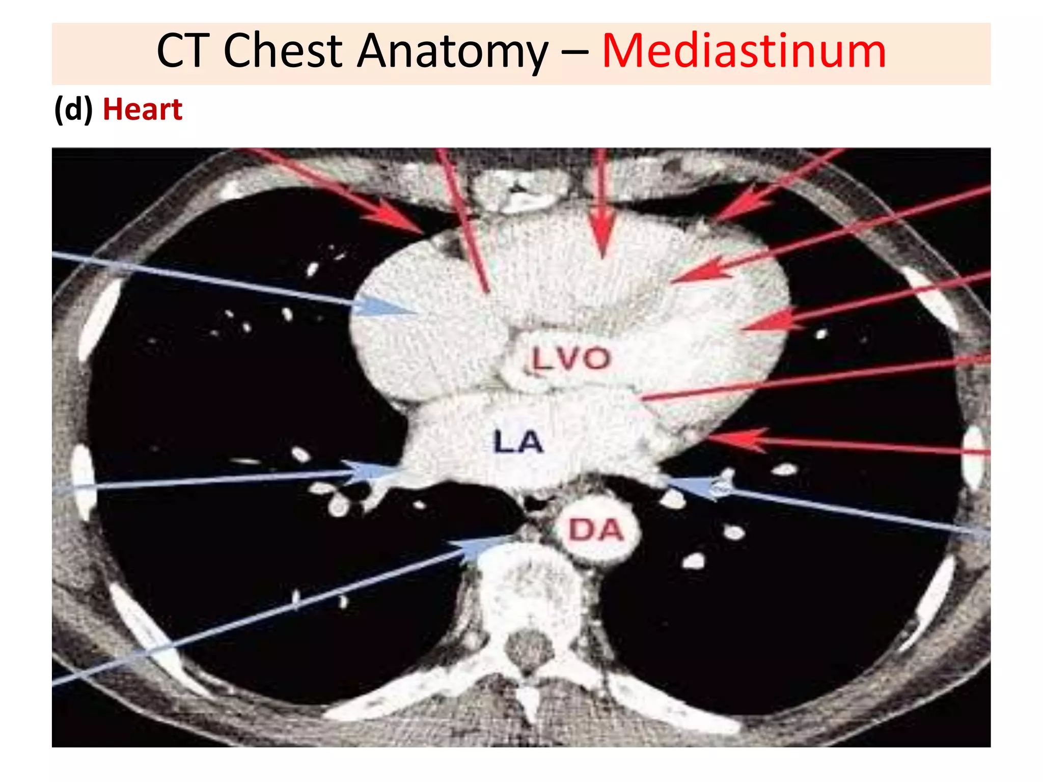 Basics of CT chest | PPTX