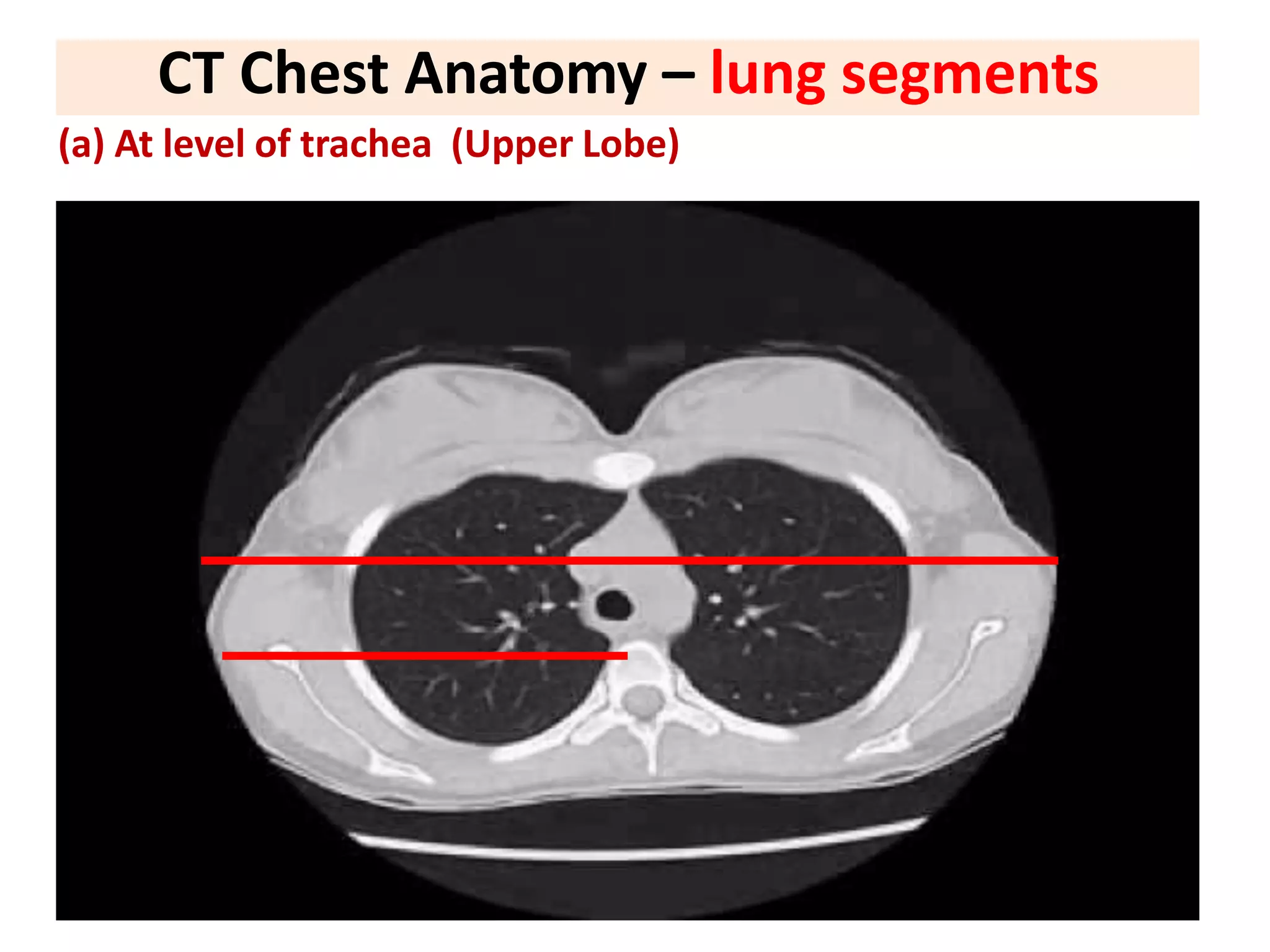Basics of CT chest | PPTX