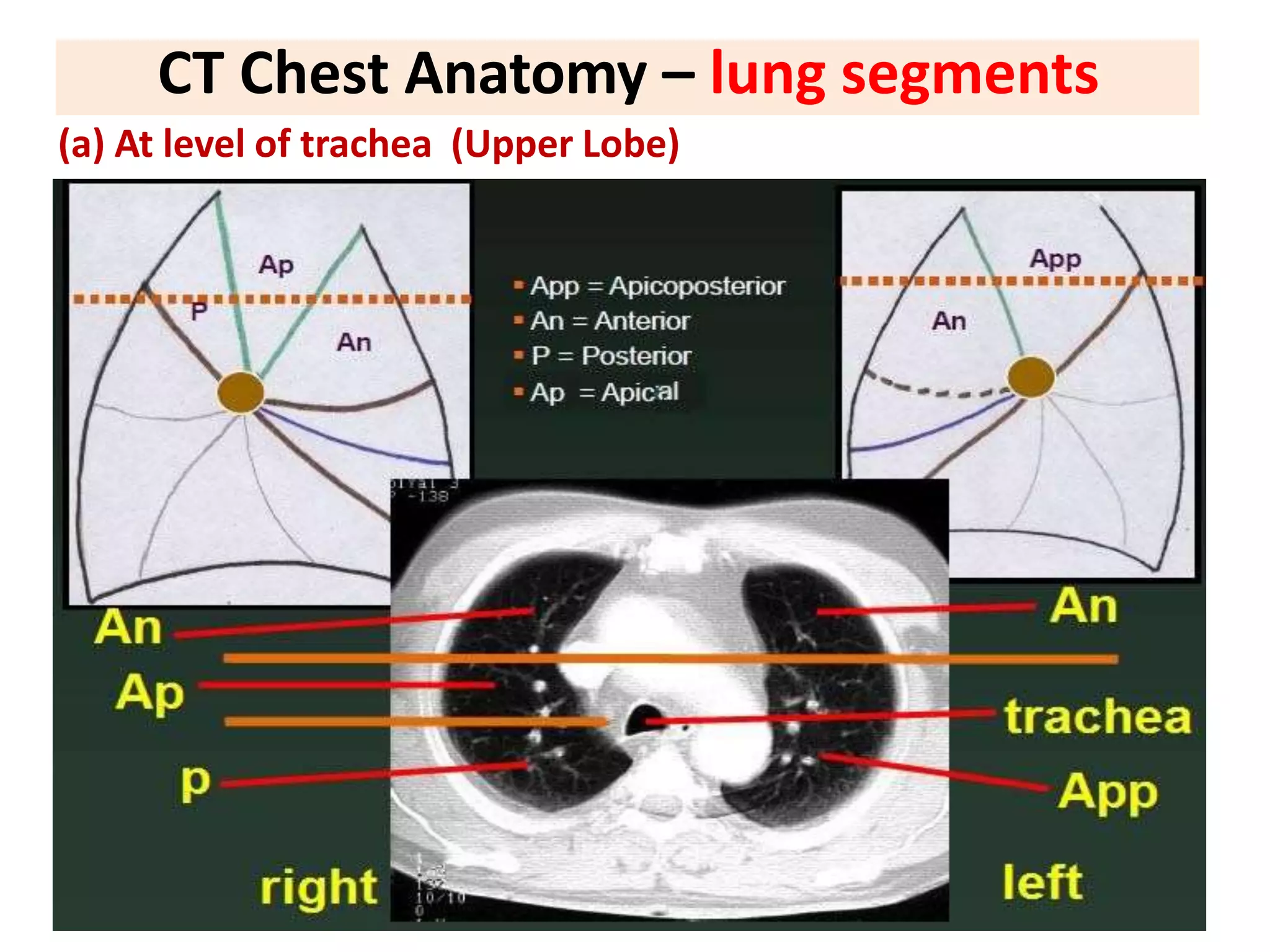 Basics of CT chest | PPTX | Lung and Respiratory Health | Diseases and ...
