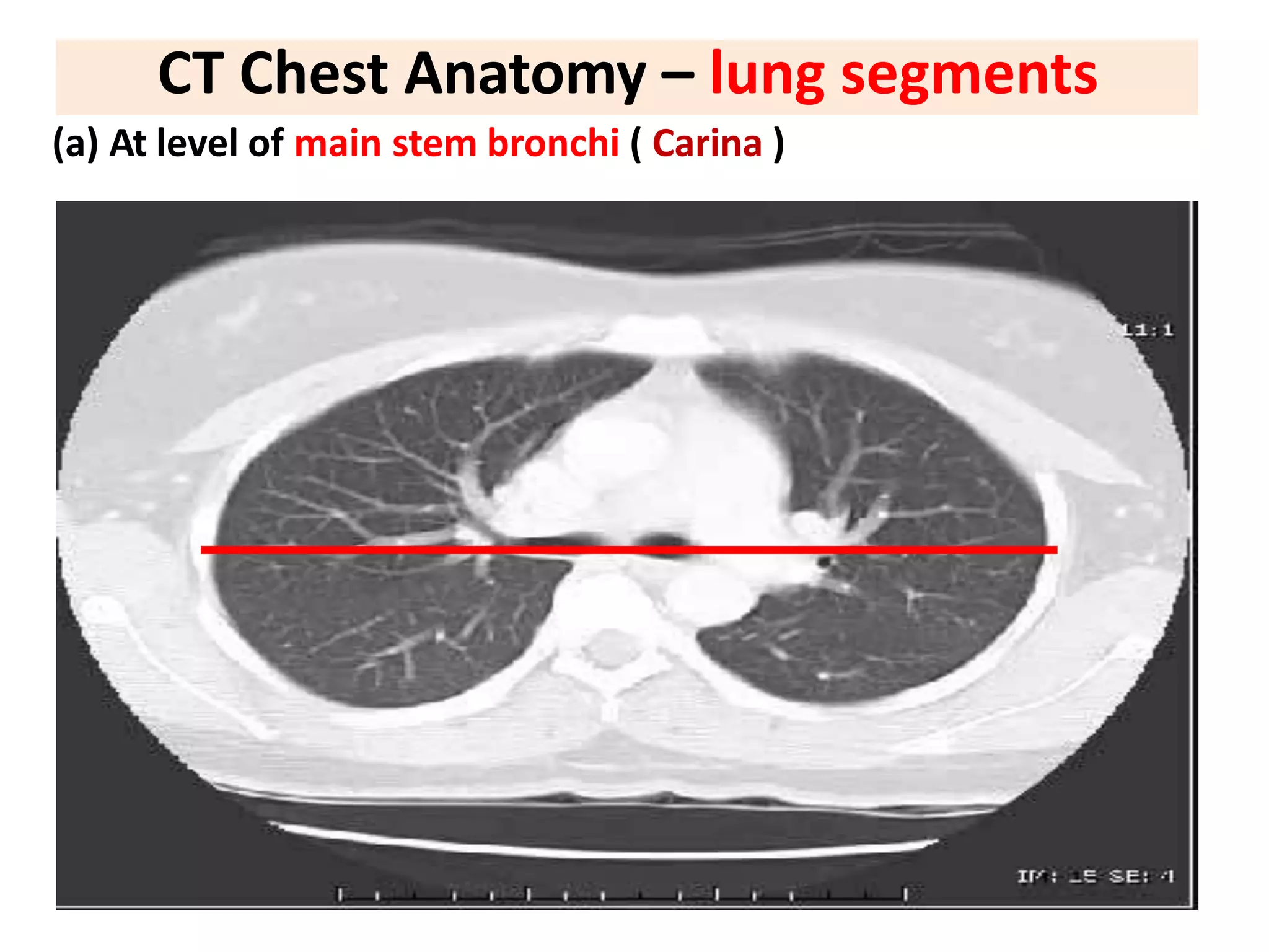 Basics of CT chest | PPTX | Lung and Respiratory Health | Diseases and ...