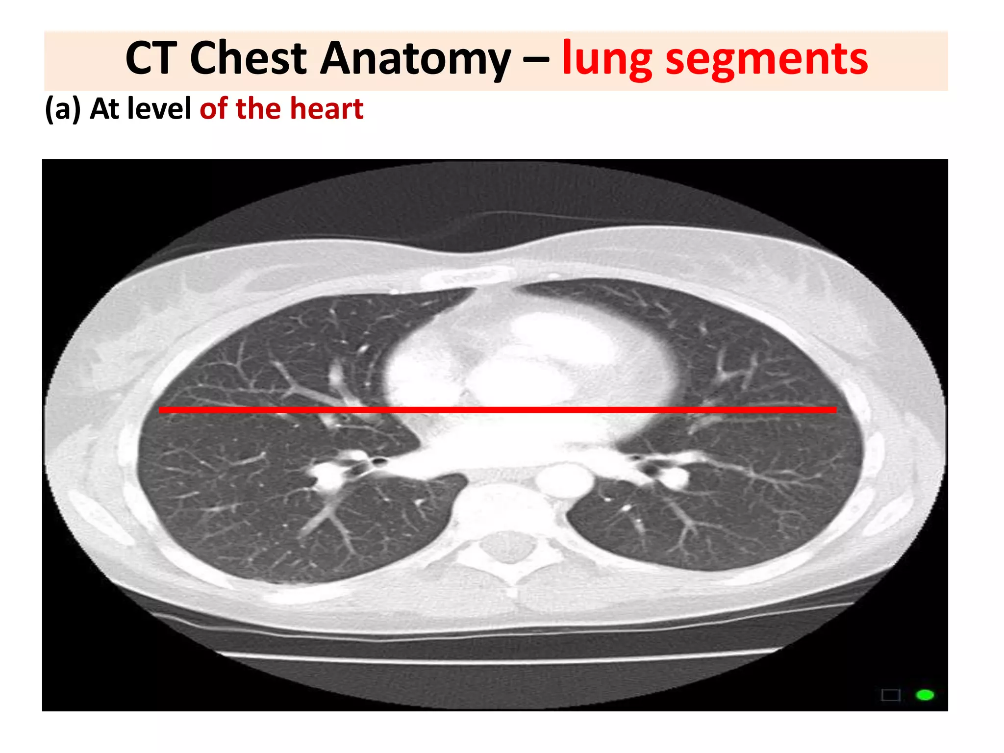 Basics of CT chest | PPTX