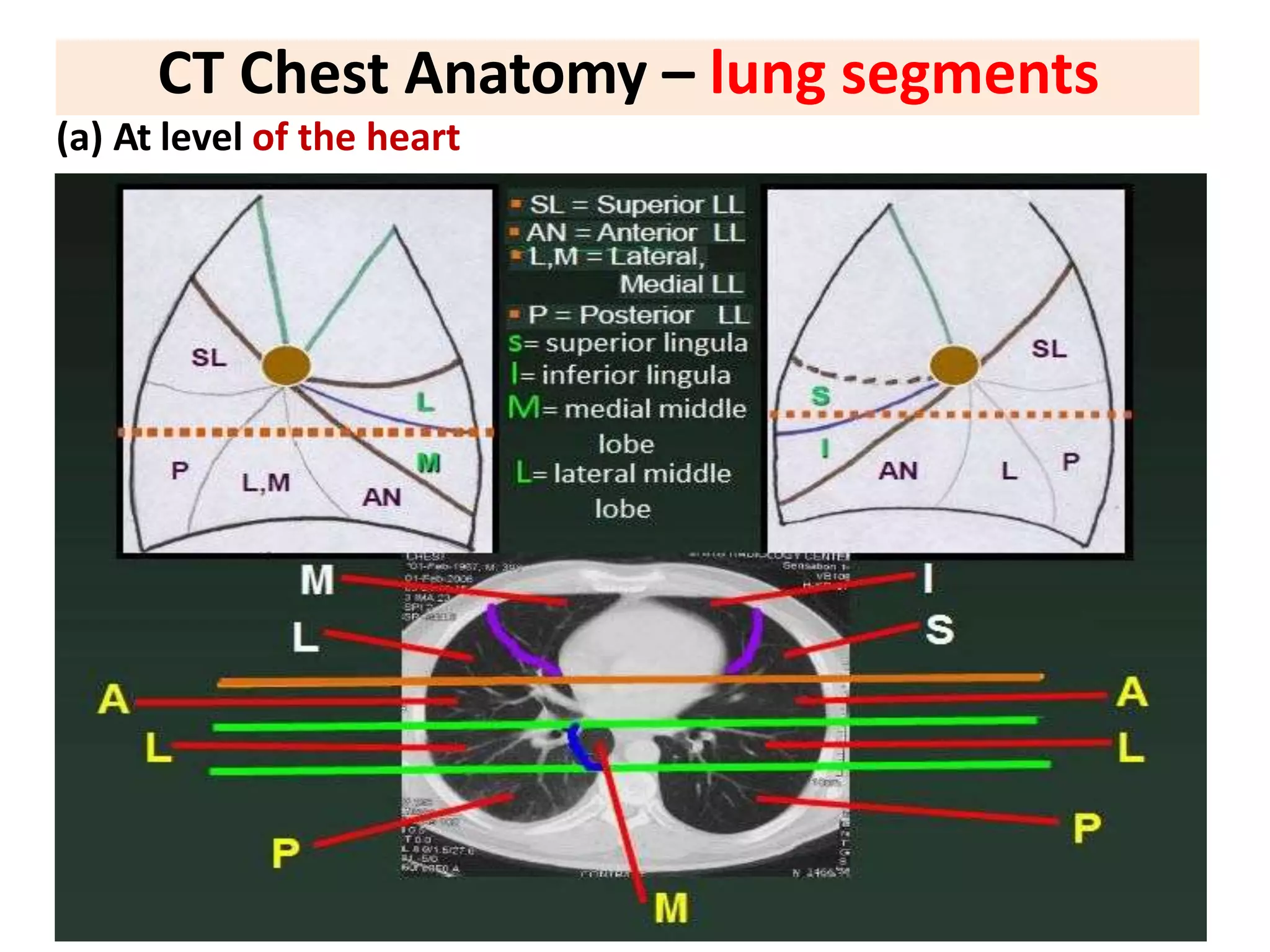 Basics of CT chest | PPTX