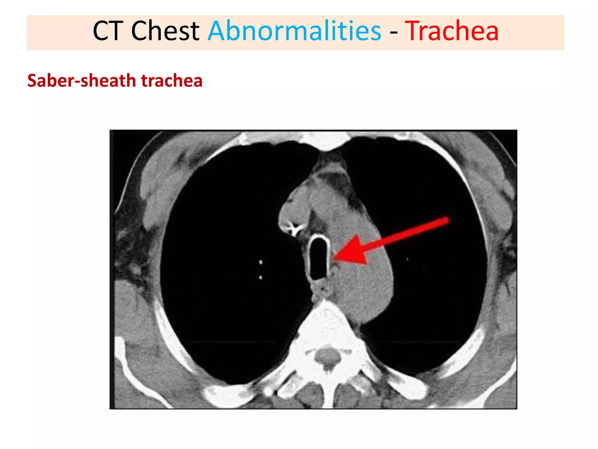 Basics of CT chest | PPTX
