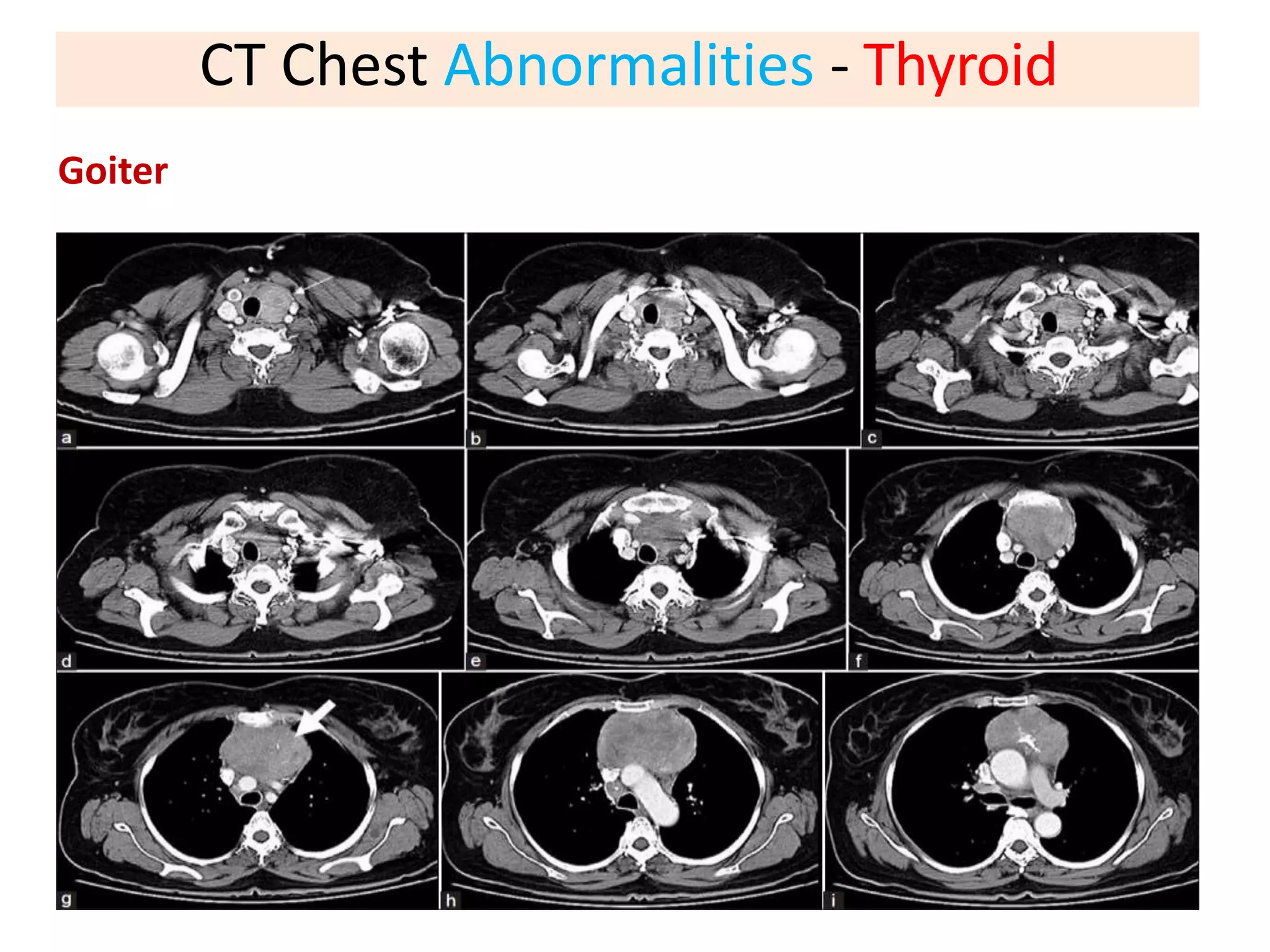 Basics of CT chest | PPTX