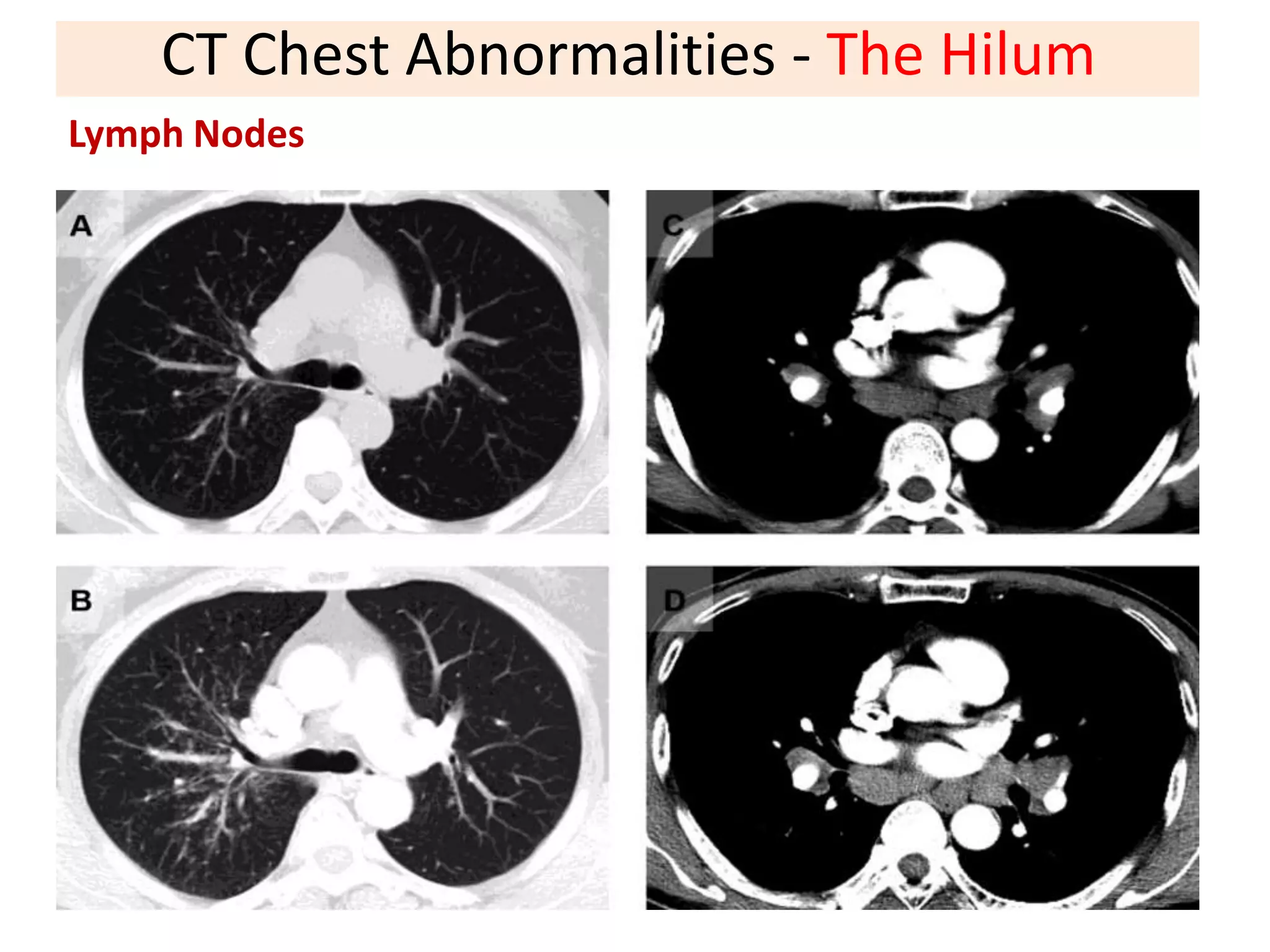 Basics of CT chest | PPTX