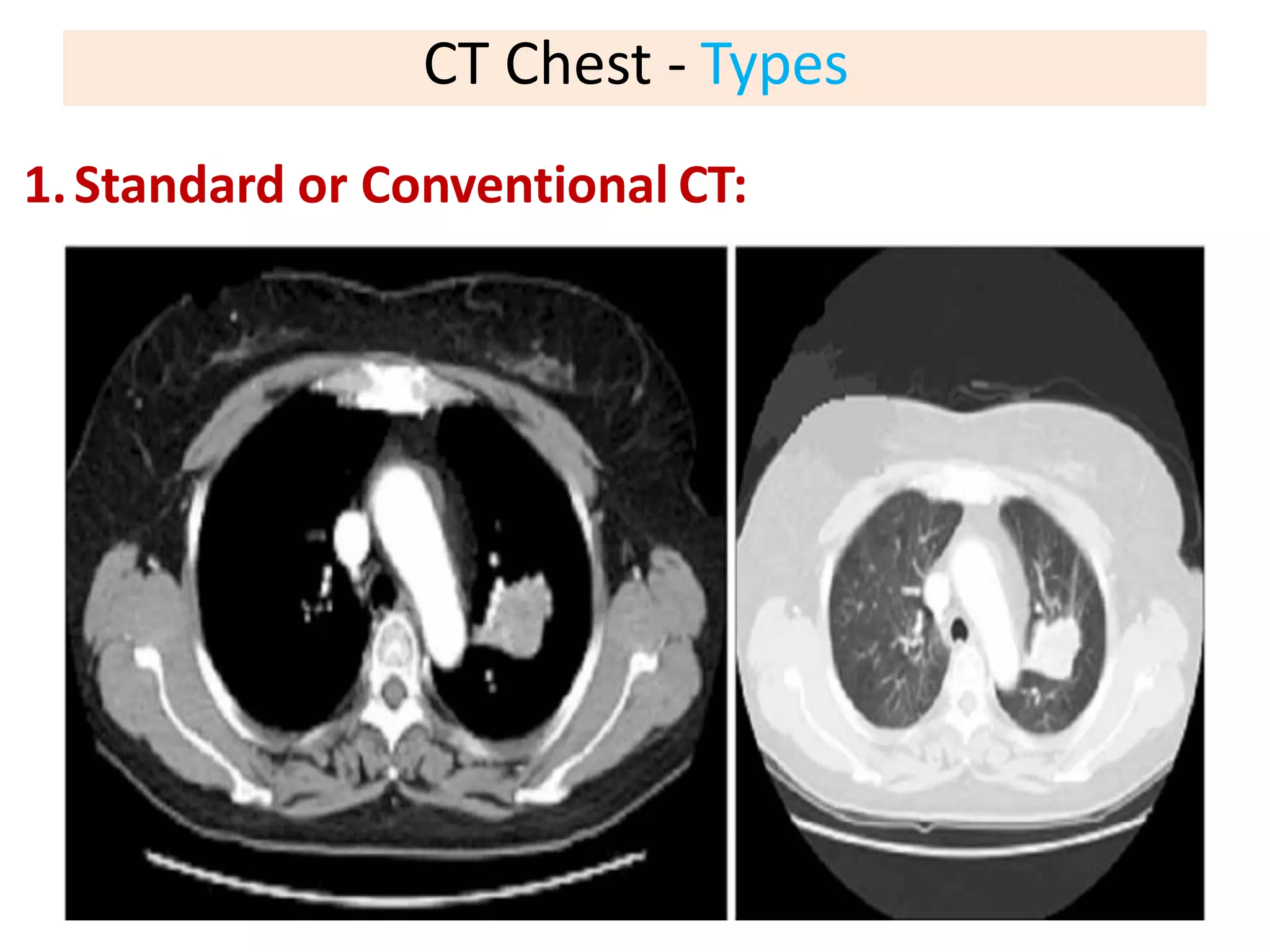 Basics of CT chest | PPTX