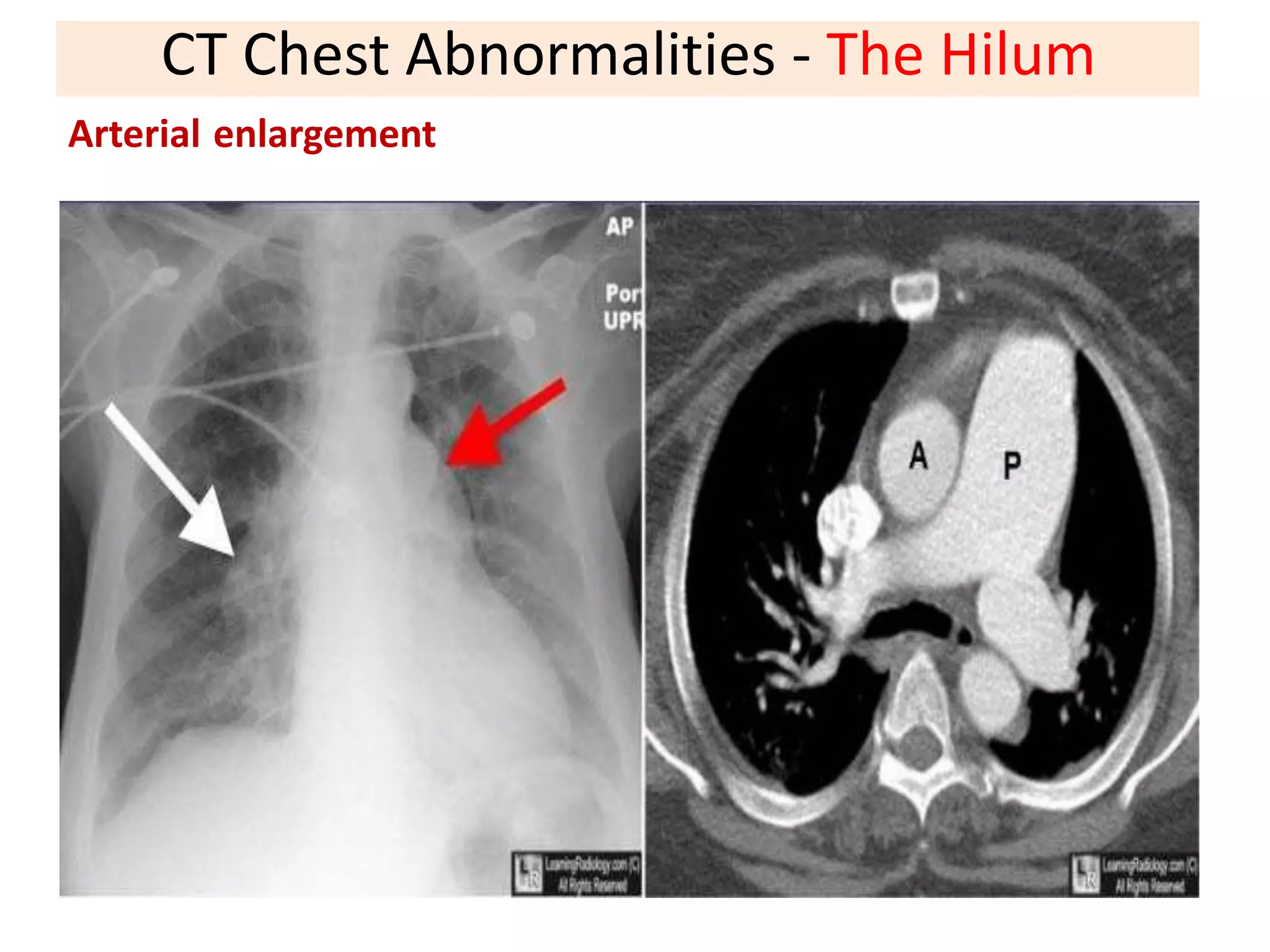 Basics of CT chest | PPTX