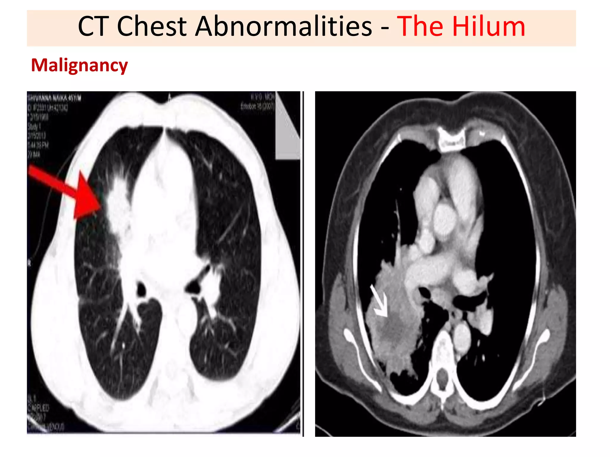 Basics of CT chest | PPTX