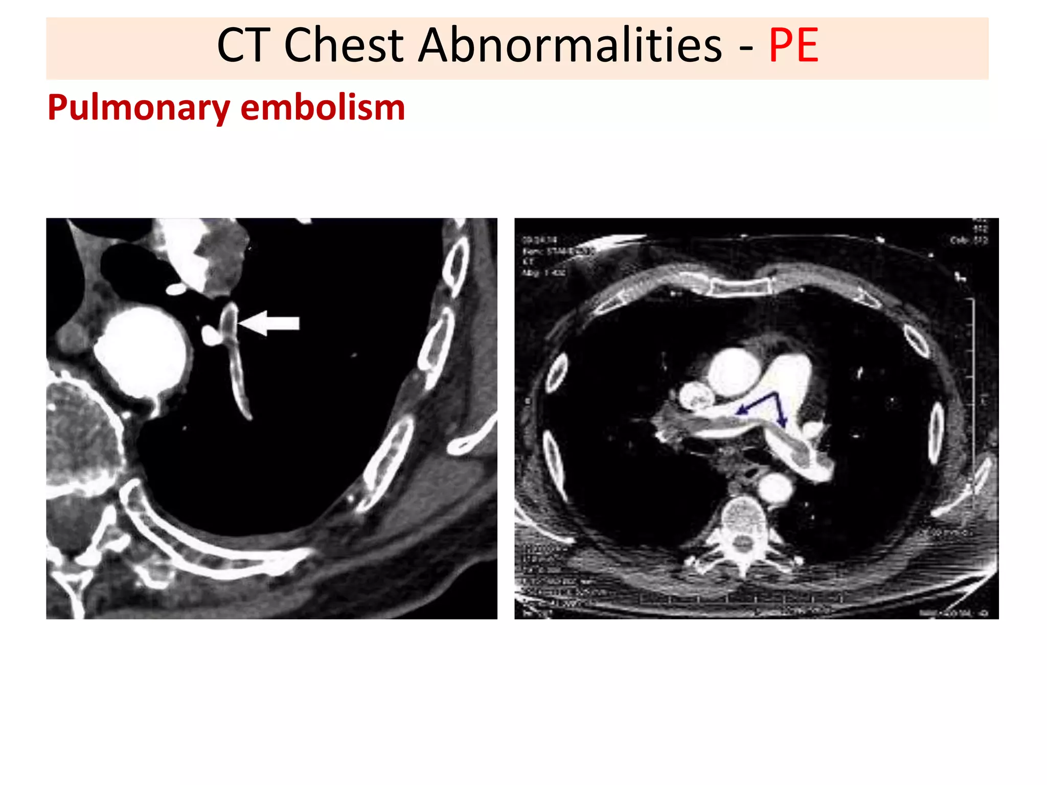 Basics of CT chest | PPTX