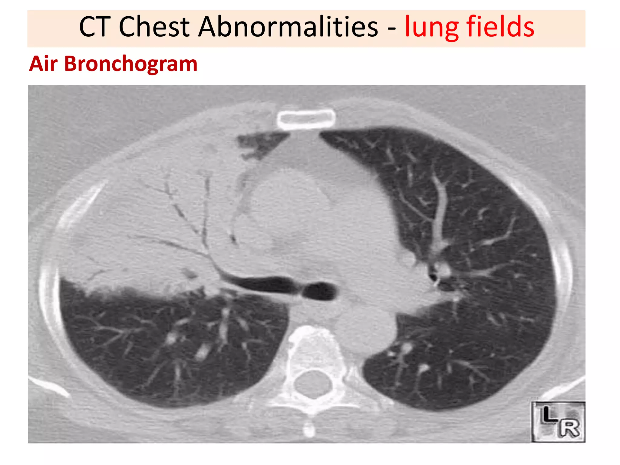Basics of CT chest | PPTX
