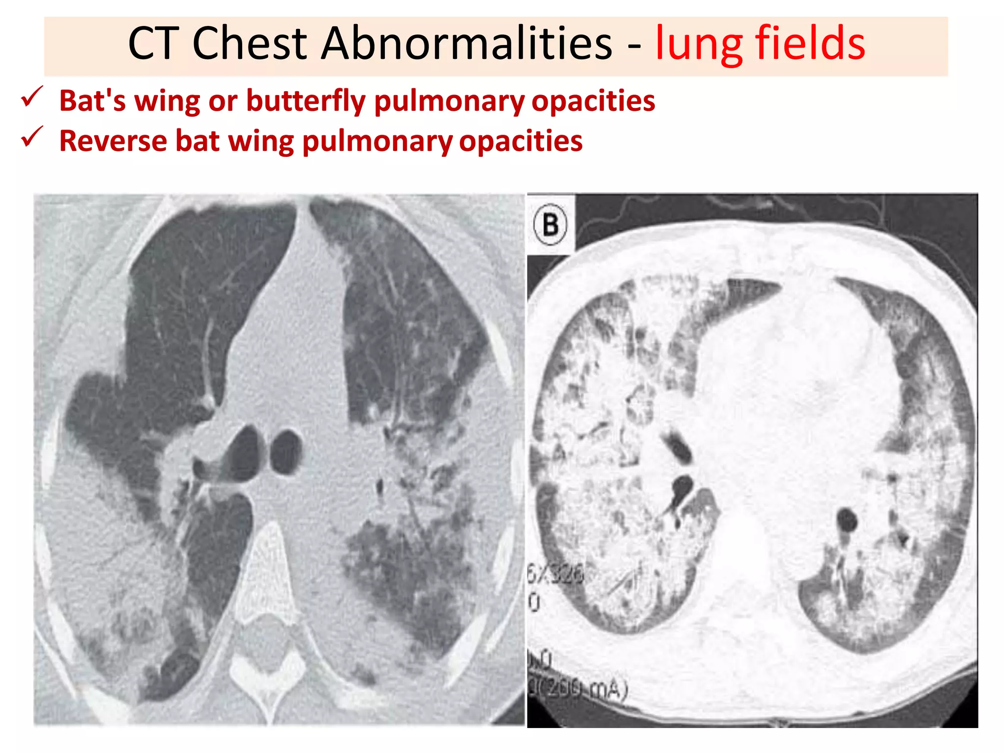 Basics of CT chest | PPTX