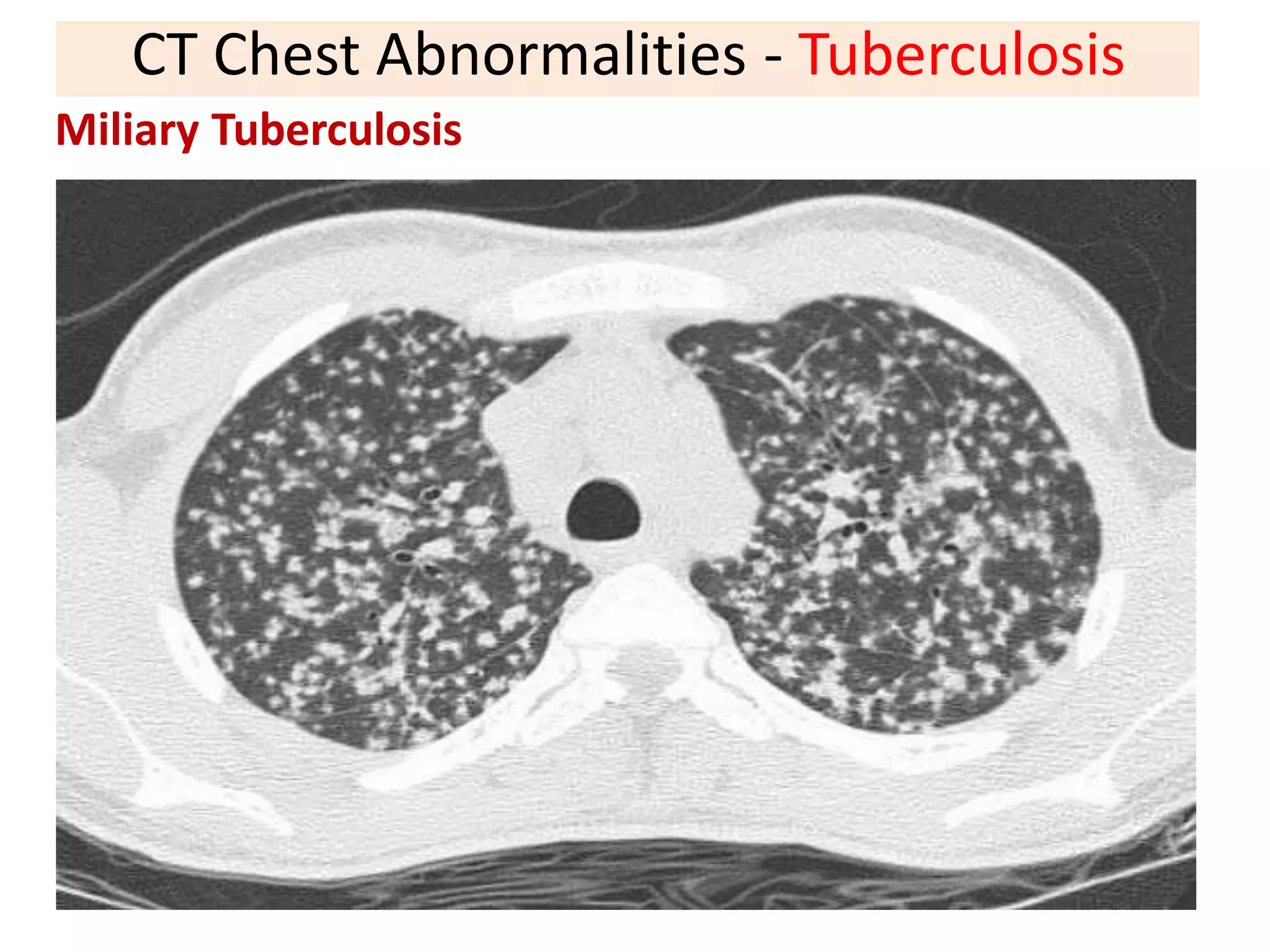 Basics of CT chest | PPTX
