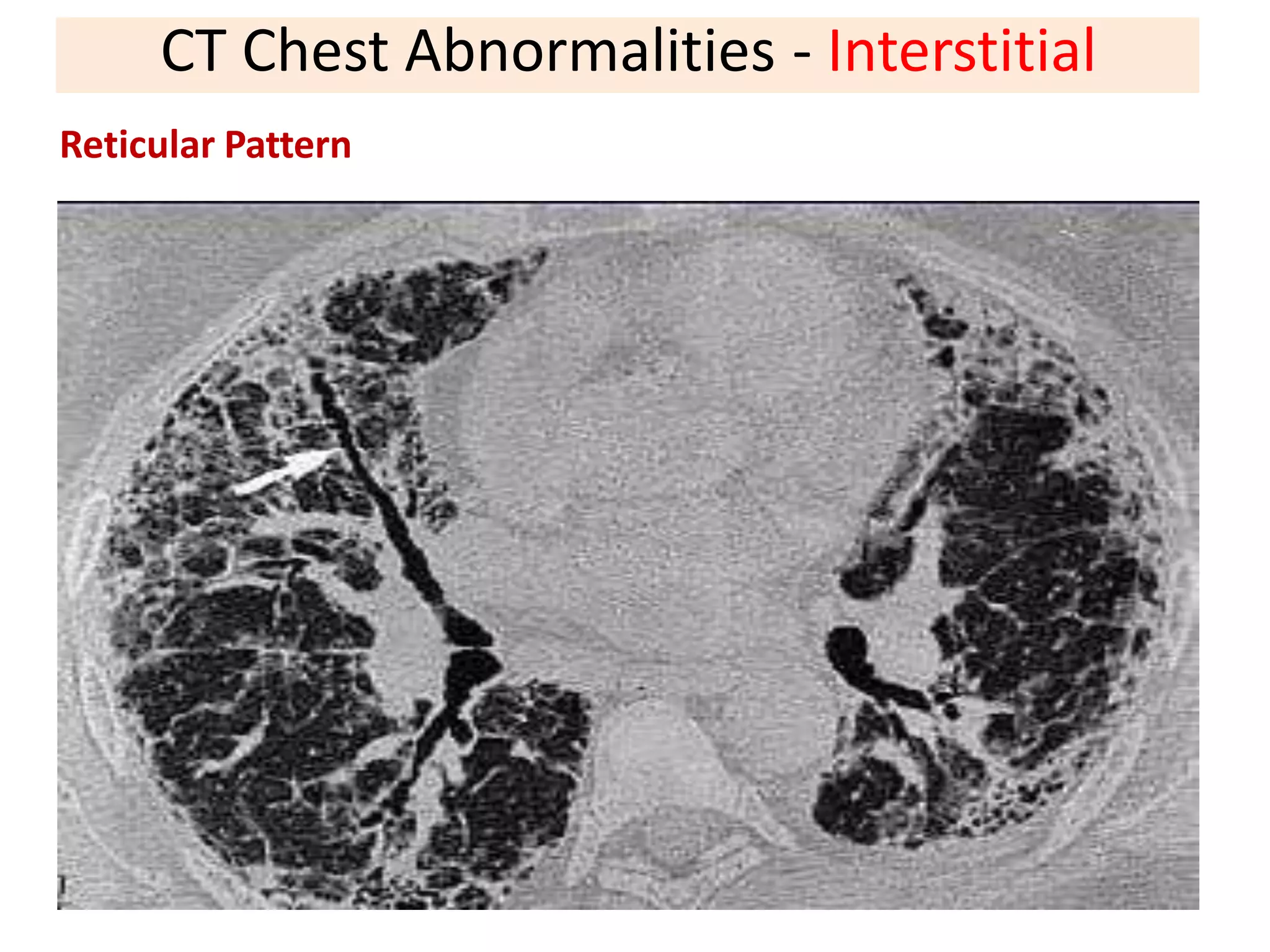 Basics of CT chest | PPTX